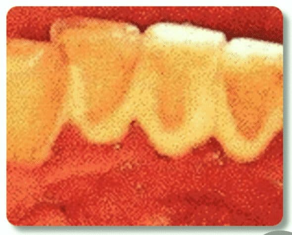 What's that gritty yellow stuff around my teeth? Dental tartar buildup